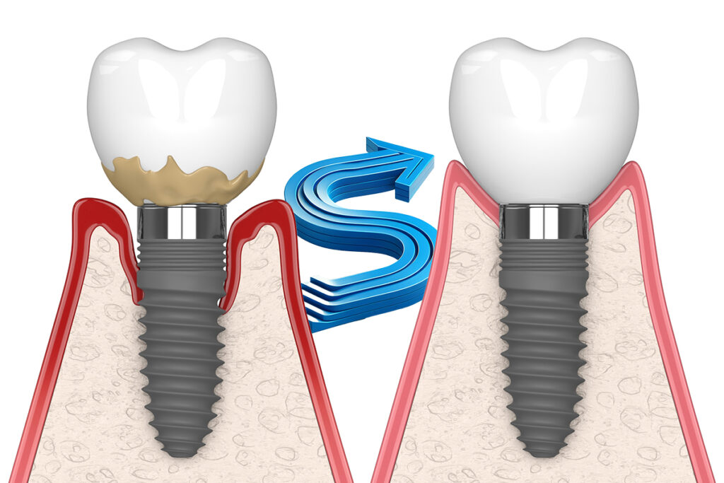 Overcoming Peri-Implantitis: Clinical Outcomes of Dental Implants in ...